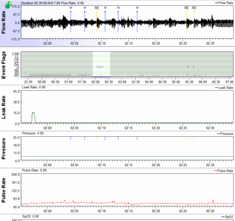 OSCAR PAP Therapy Data Analysis Consultation | AXG Sleep Diagnostics