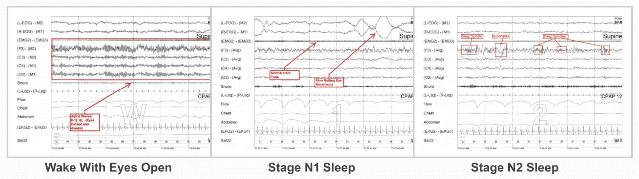 Sleep Stages During Sleep | AXG Sleep Diagnostics