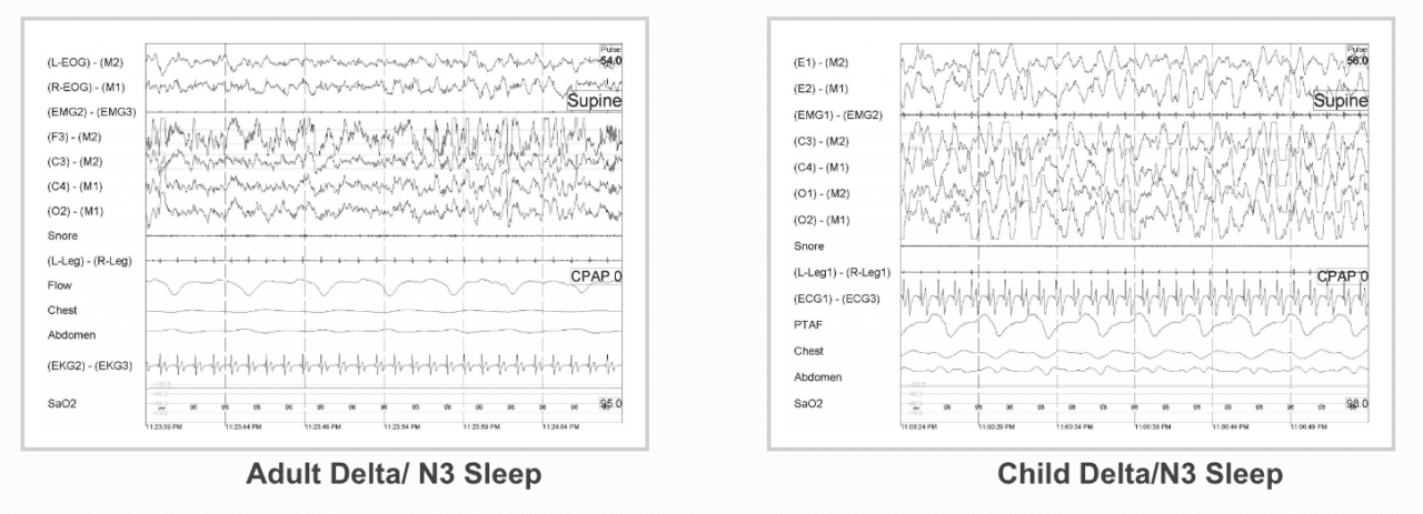 Sleep Stages During Sleep | AXG Sleep Diagnostics