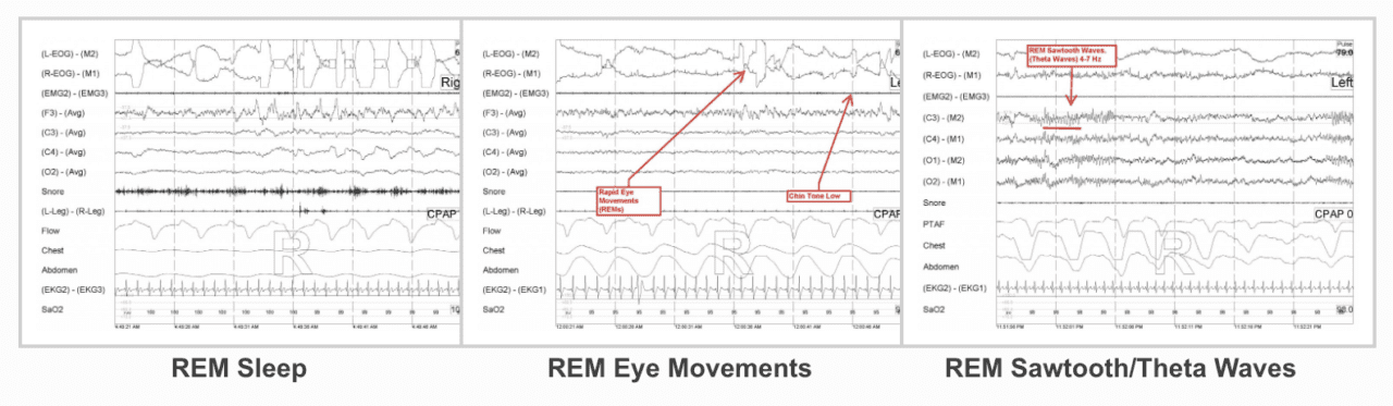 Sleep Stages During Sleep - AXG Sleep Diagnostics
