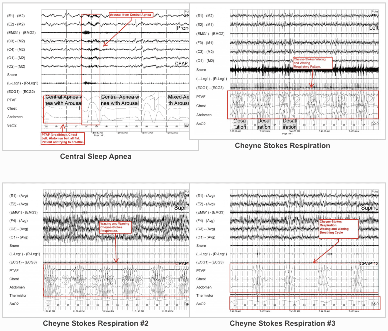Sleep Breathing Disorders | AXG Sleep Diagnostics